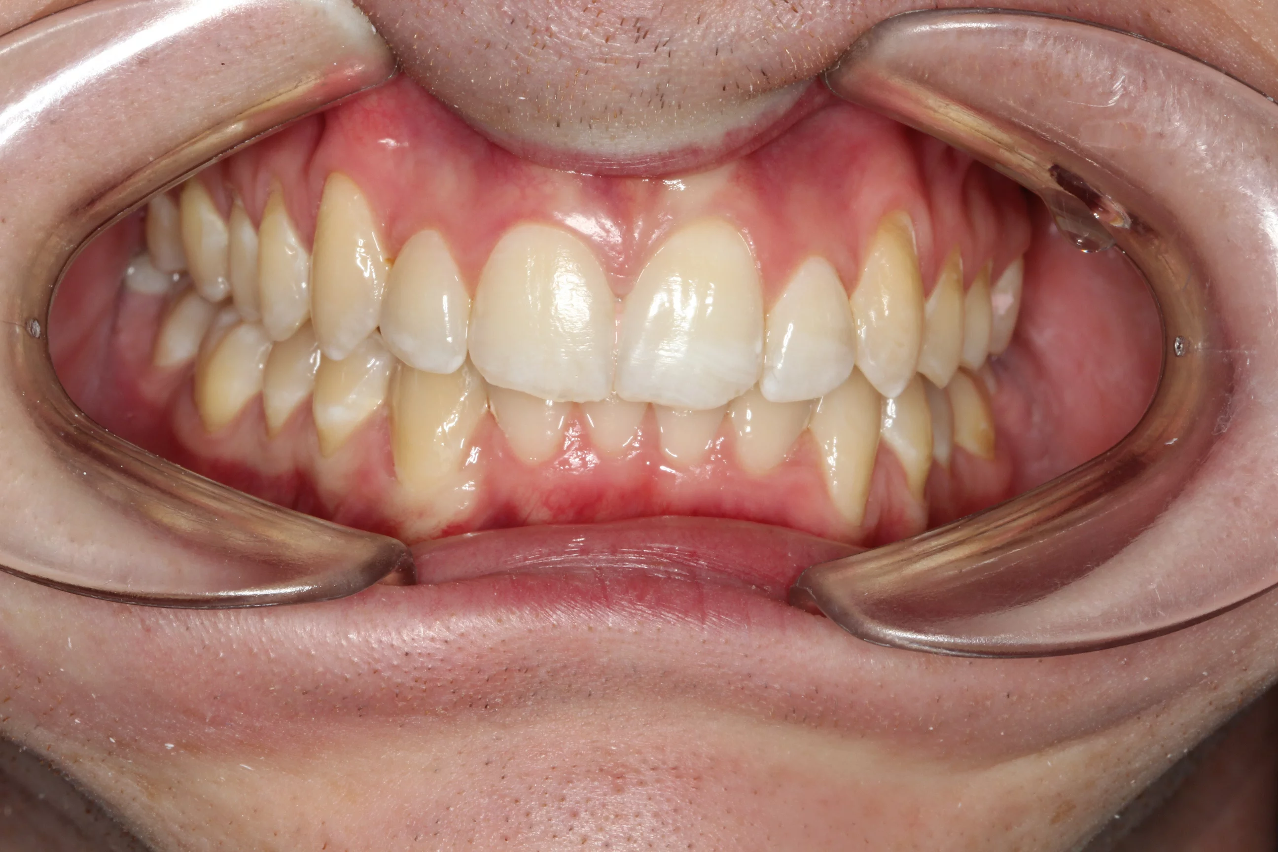 Invisalign Case Study - Holland Park Dental