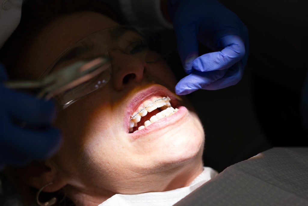 BLOG | How are braces removed? | Quick & Easy Brace Removal