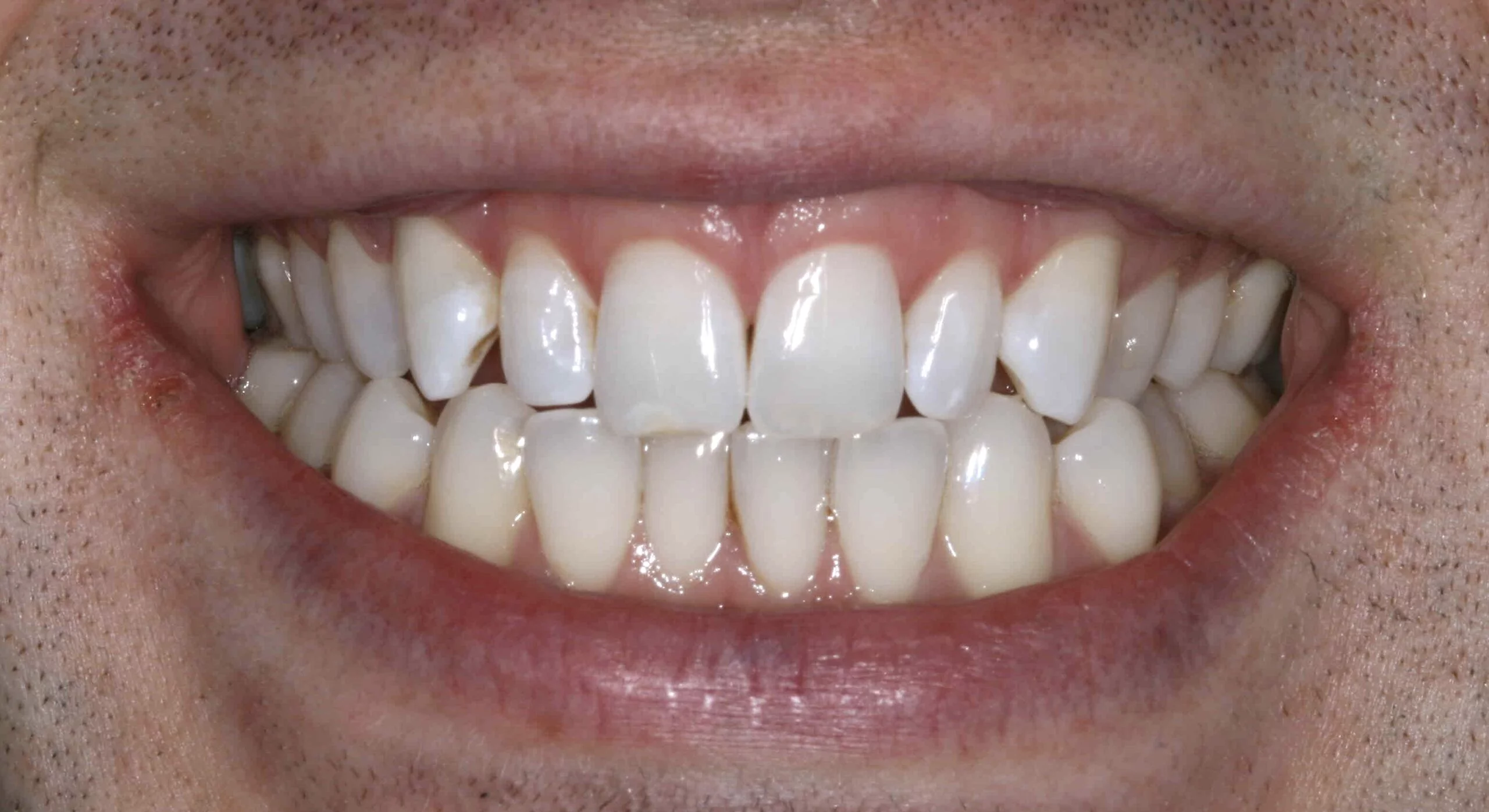 ICON Treatment Results | White Spot Lesion Removal