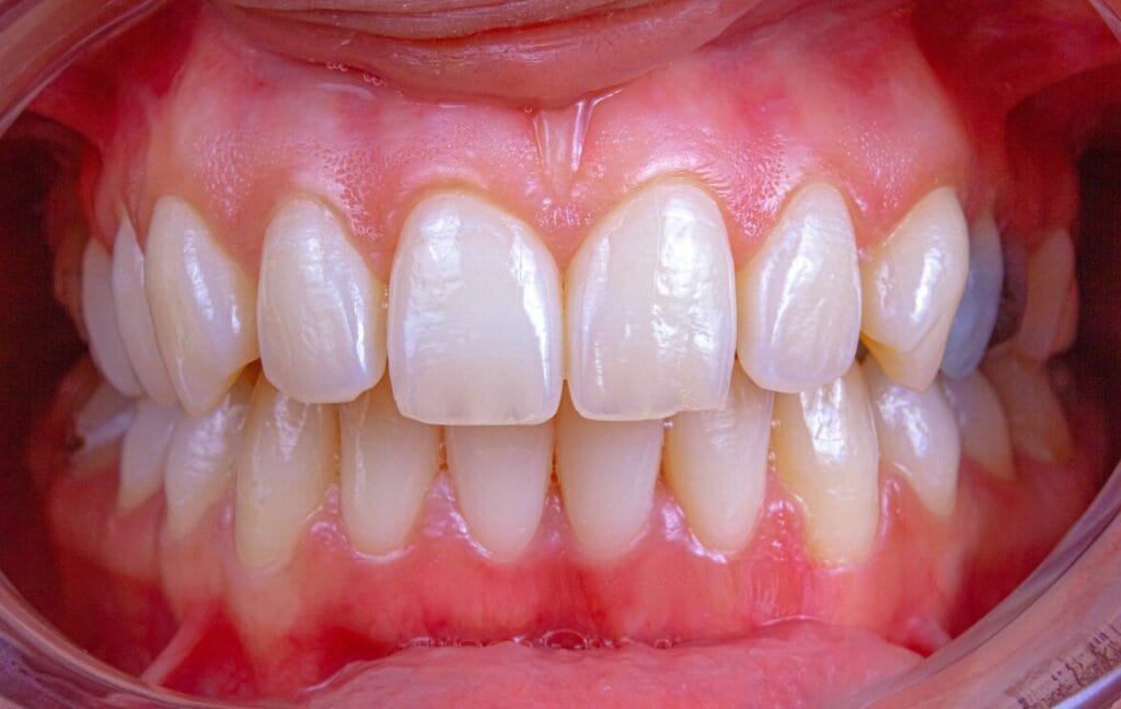 Bleeding Gums – Are They Really That Bad? – Holland Park Dental